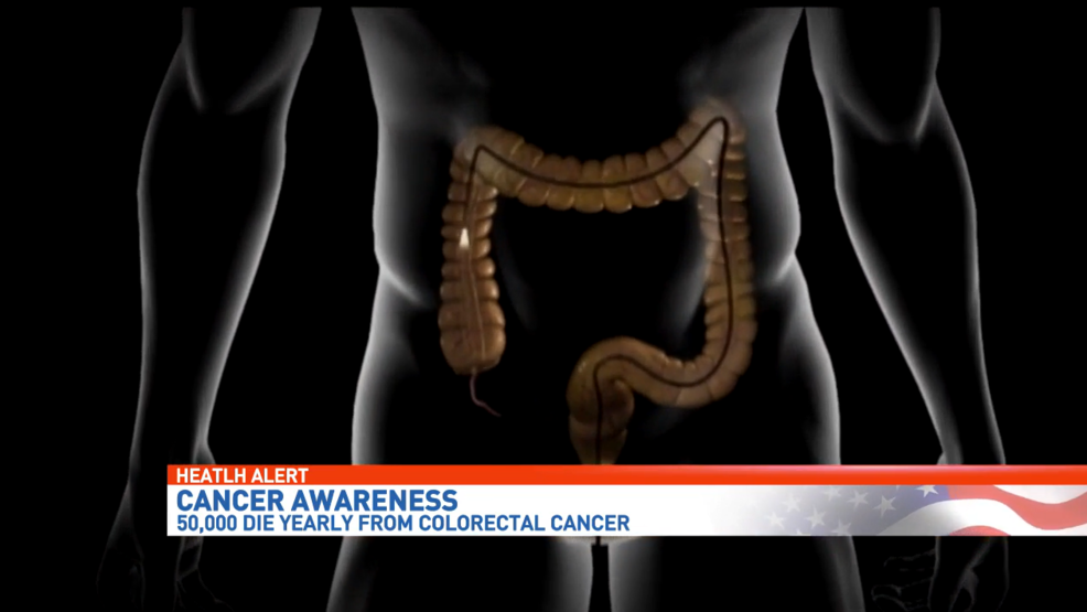 Colon cancer screening can save your life | WEAR